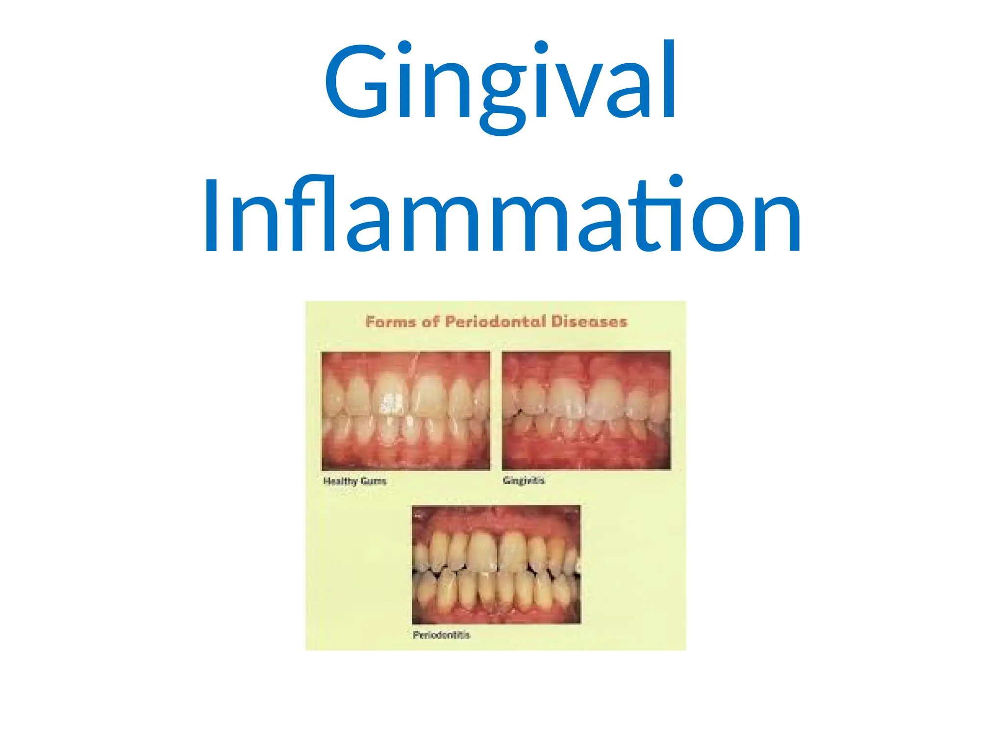 Gingival inflammation and stages of gingivitis.pptx