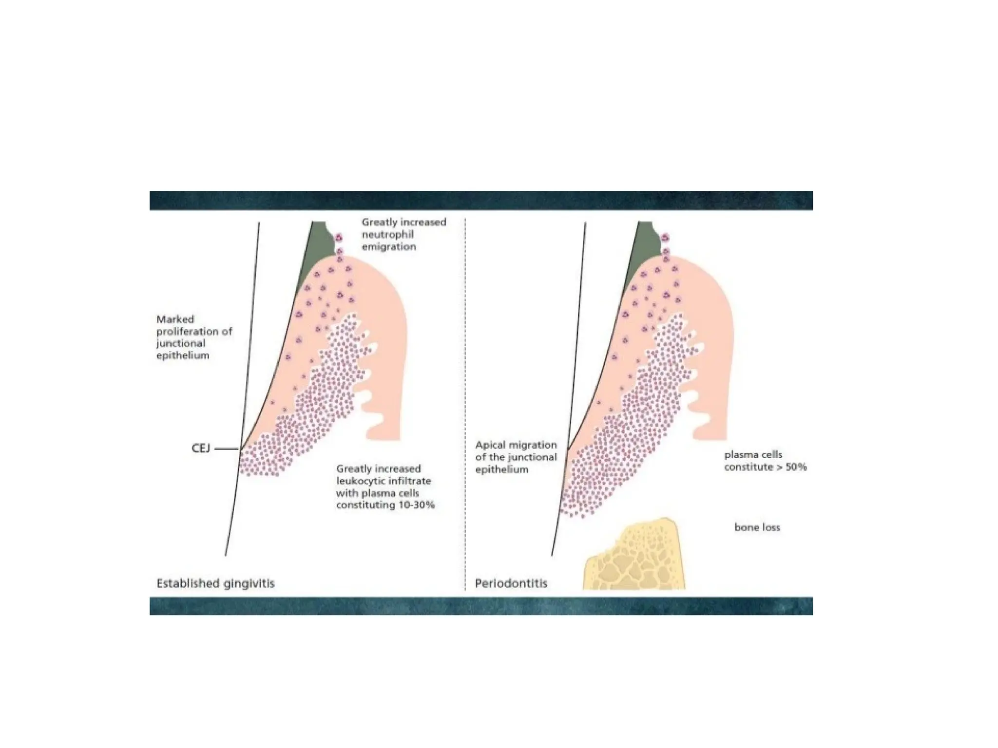Gingival inflammation and stages of gingivitis.pptx