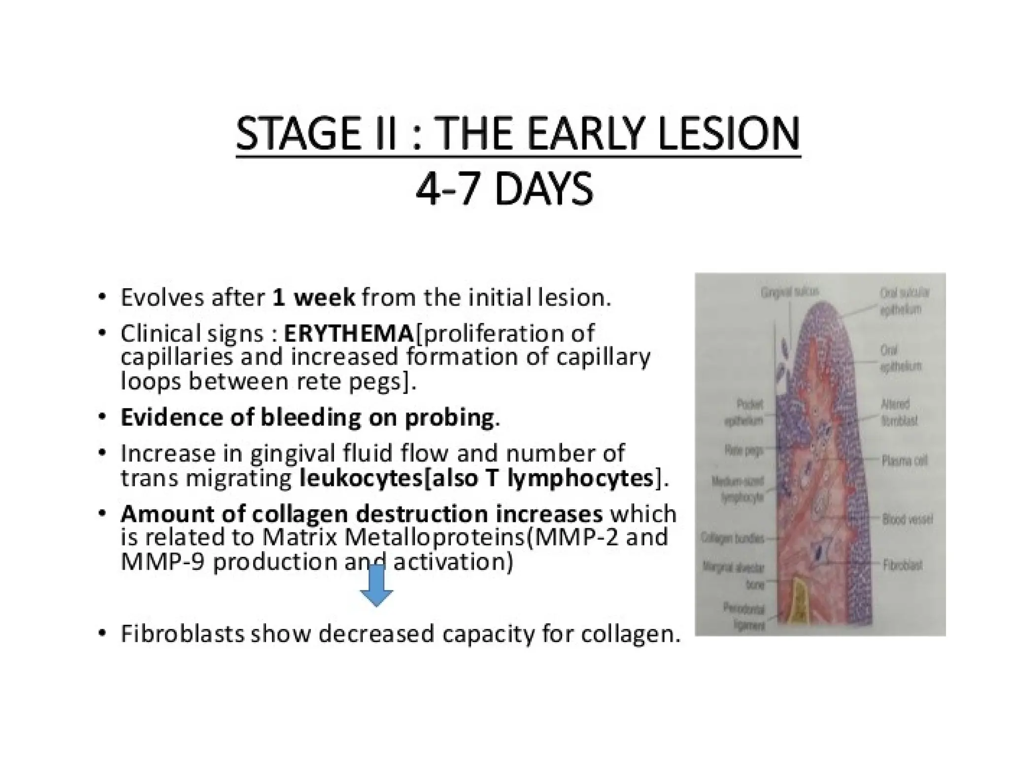 Gingival inflammation and stages of gingivitis.pptx