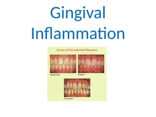 Gingival inflammation and stages of gingivitis.pptx
