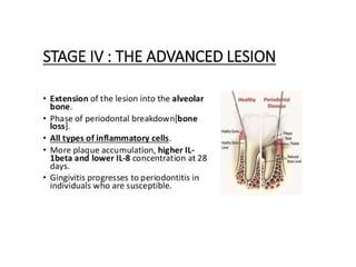 Gingival inflammation and stages of gingivitis.pptx