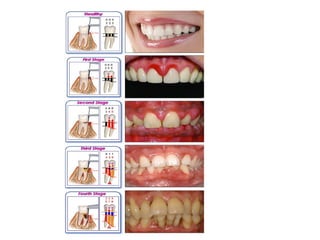 Gingival inflammation and stages of gingivitis.pptx