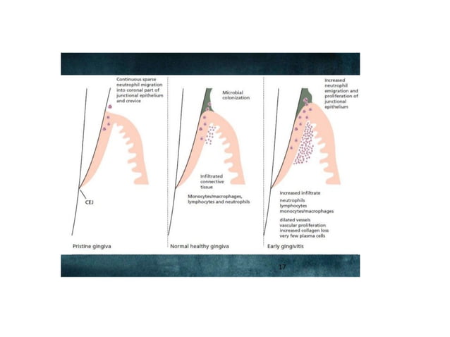 Gingival inflammation and stages of gingivitis.pptx