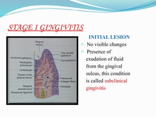 GINGIVAL INFLAMMATION- Classification and management | PPTX