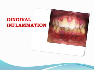 GINGIVAL INFLAMMATION in periodontics | PPTX