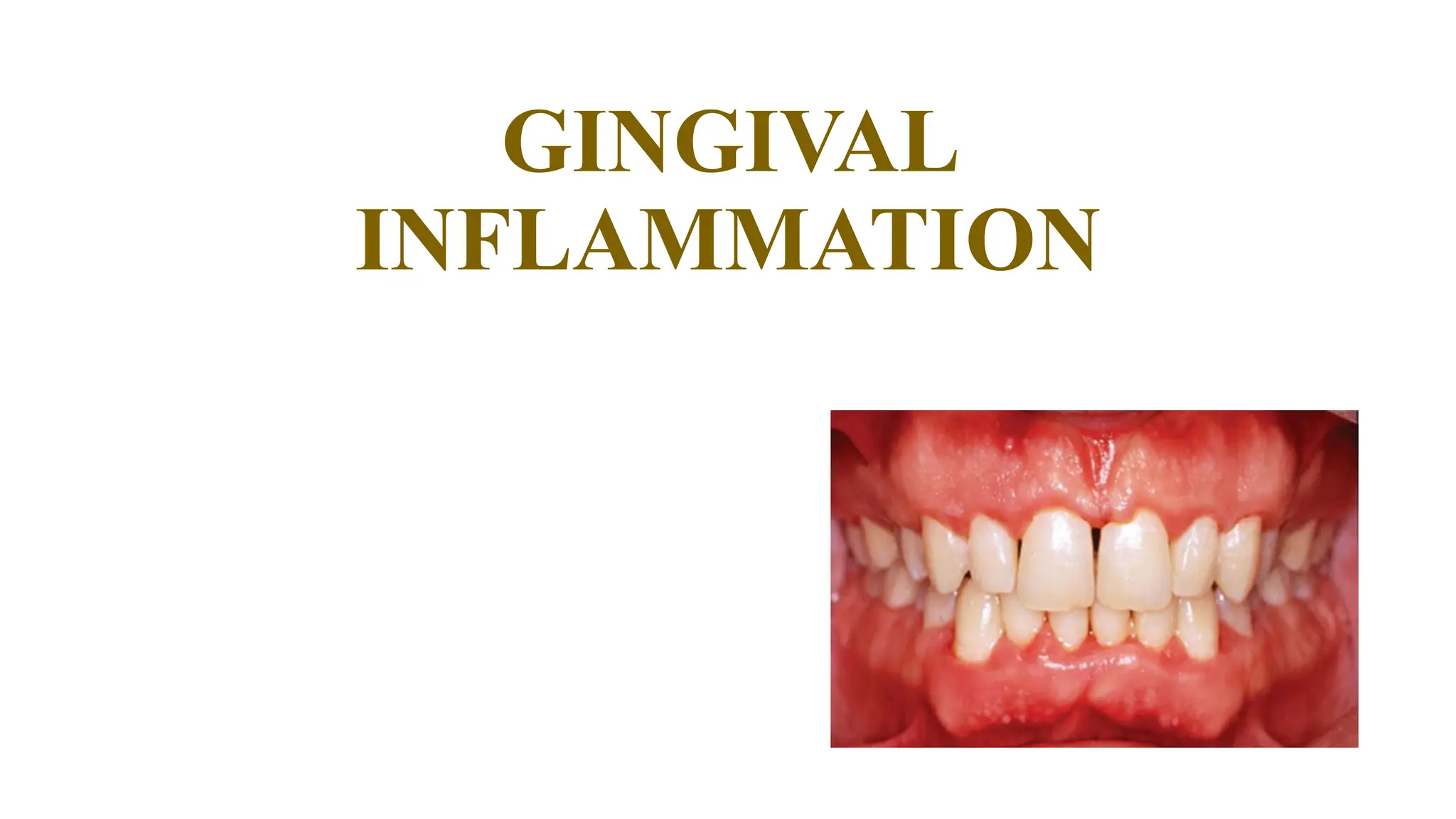 Gingival inflammation- Group B presentation.pptx