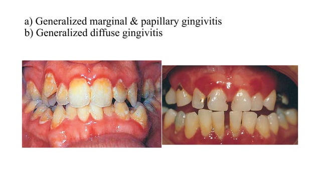 Gingival inflammation- Group B presentation.pptx