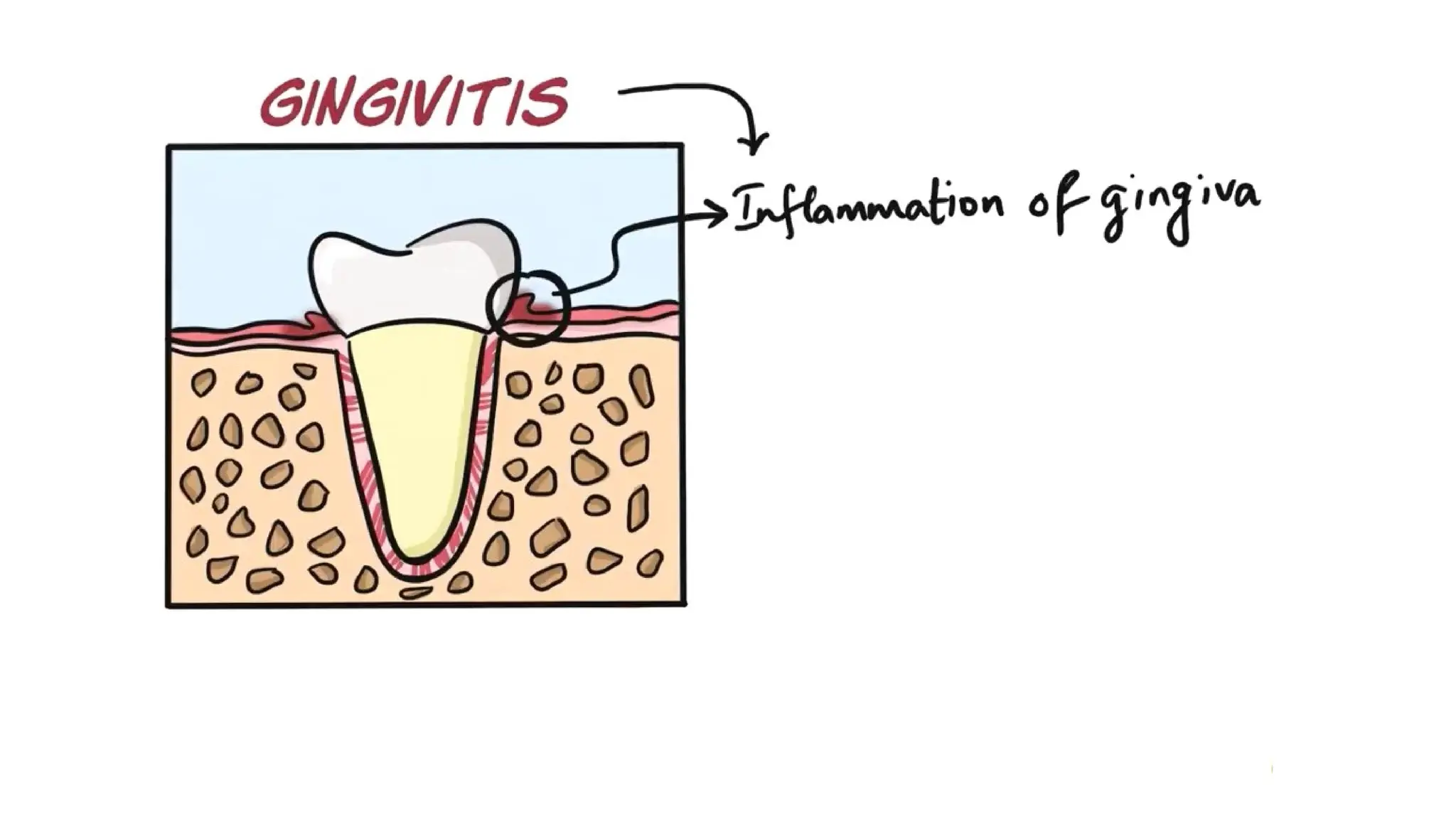 Gingival Inflammation and its clinical features.pptx