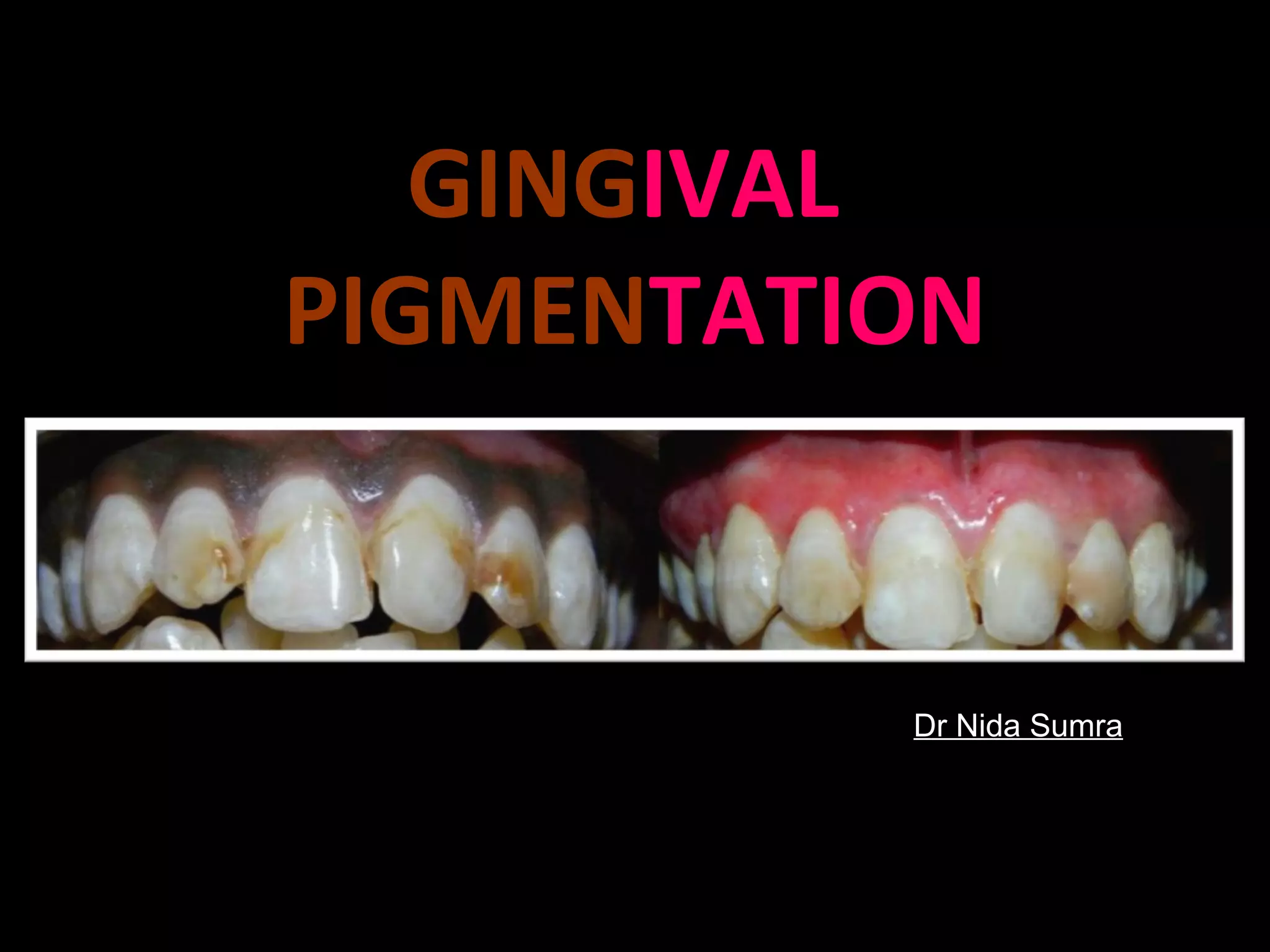 Gingival pigmentation | PPT