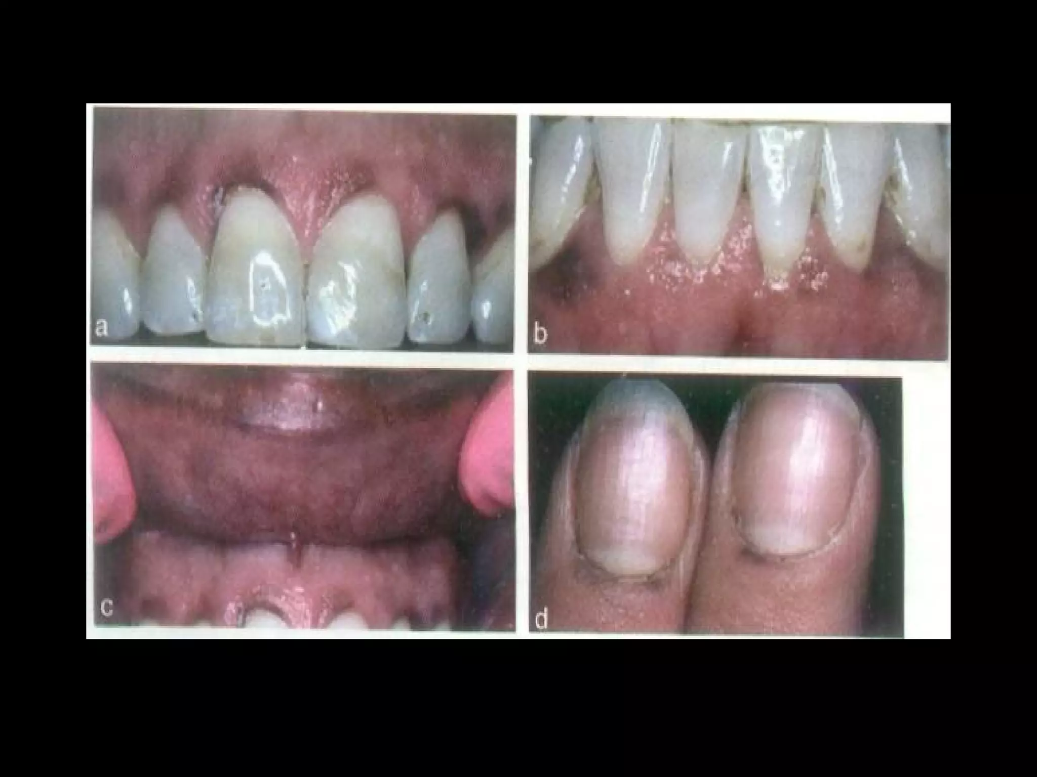 Gingival pigmentation | PPT