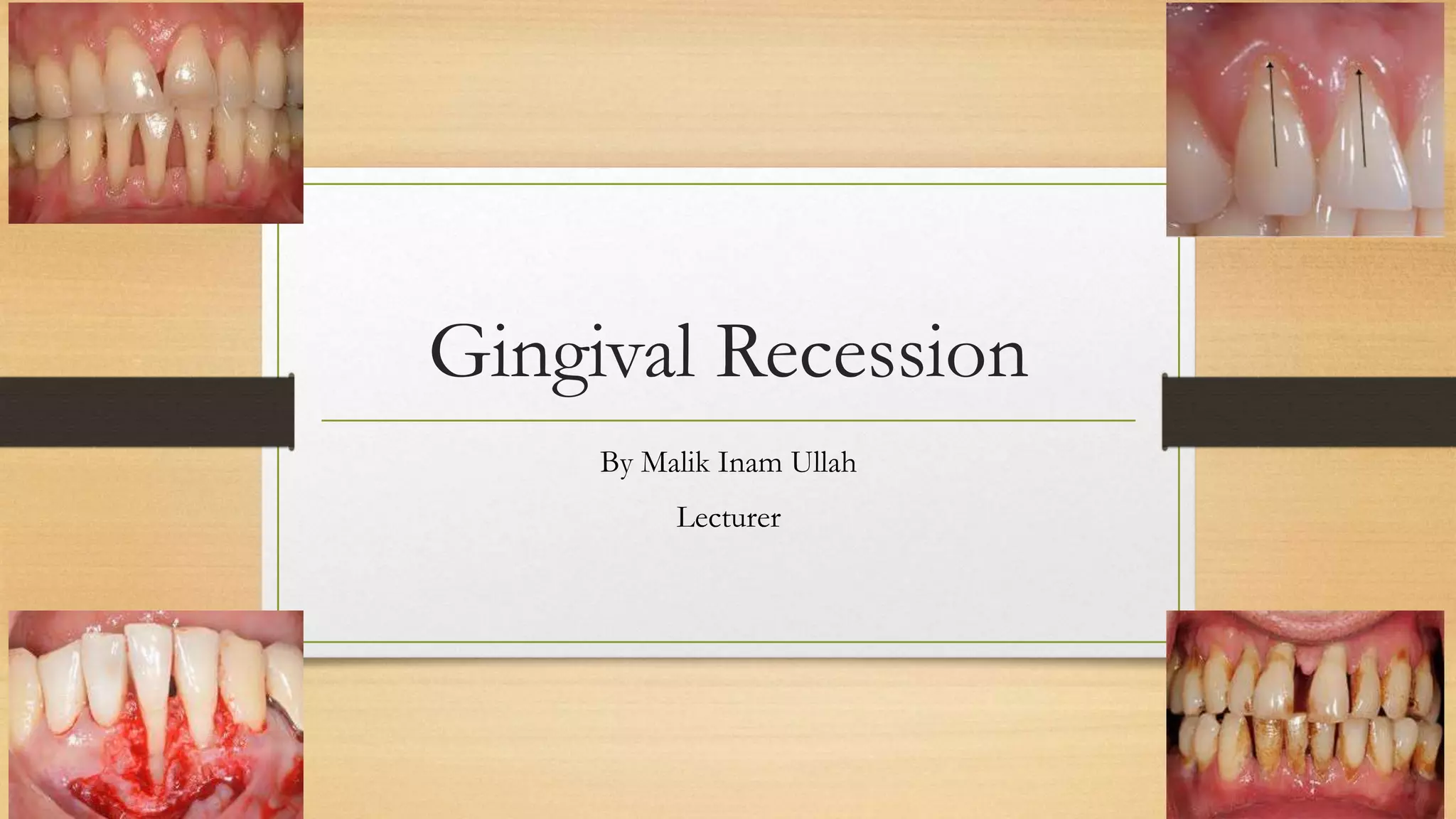 Gingival Recession, Gums Recession, | PPTX