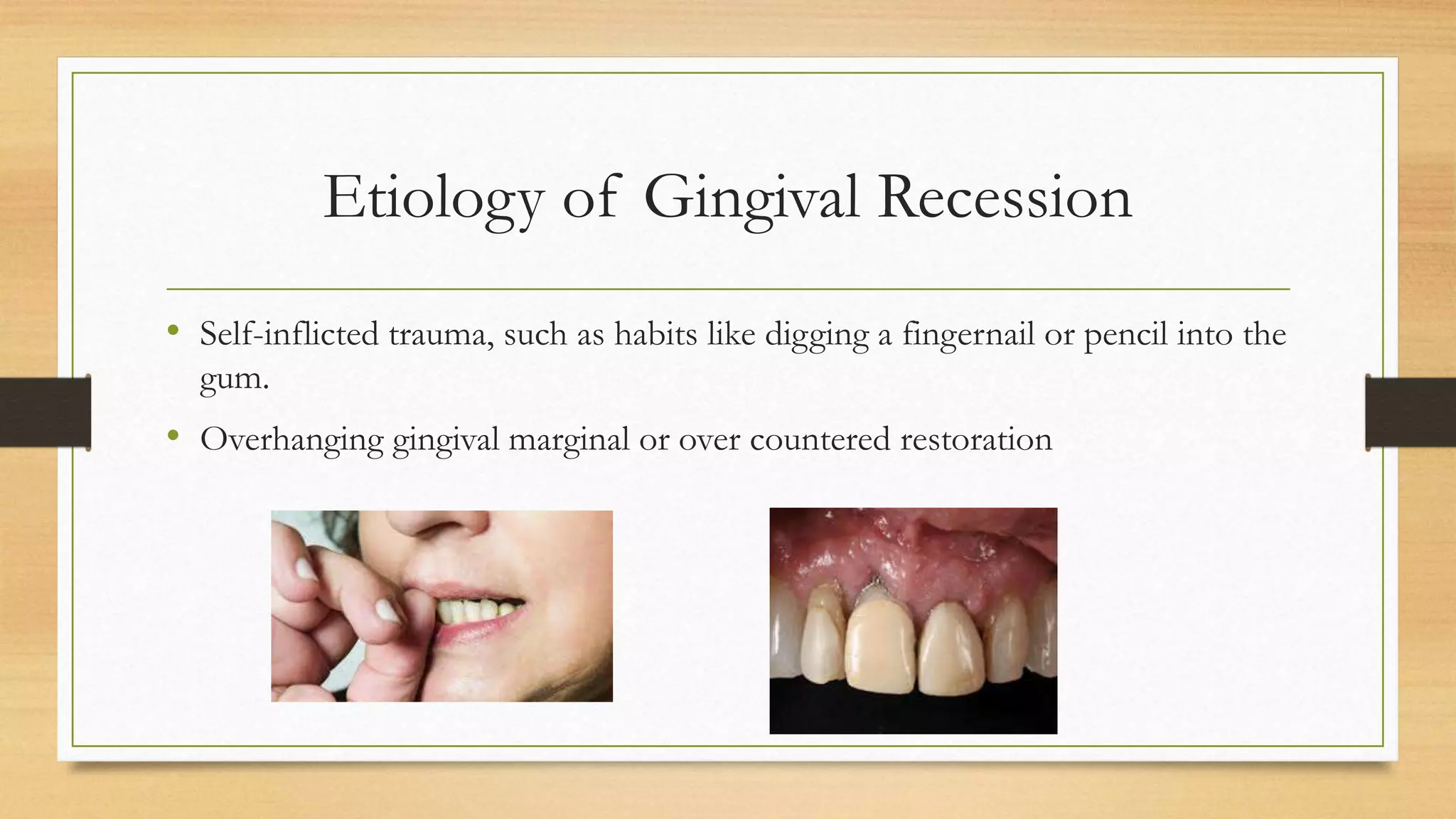 Gingival Recession, Gums Recession, | PPTX