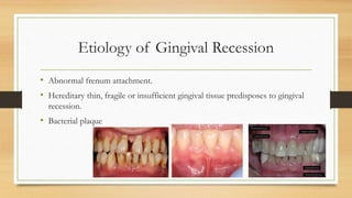 Gingival Recession, Gums Recession, | PPTX