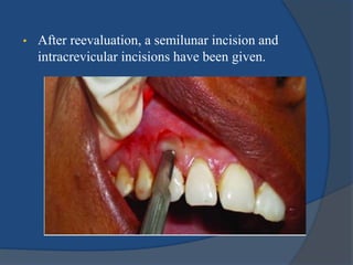 Gingival Recession - 3 Case Reports | PPTX