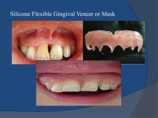 Gingival Recession - 3 Case Reports | PPTX