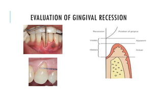 Gingival Recession.pptxhsudueheueduehhehehe | PPTX