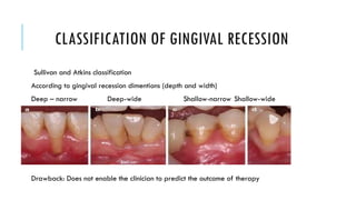 Gingival Recession.pptxhsudueheueduehhehehe | PPTX