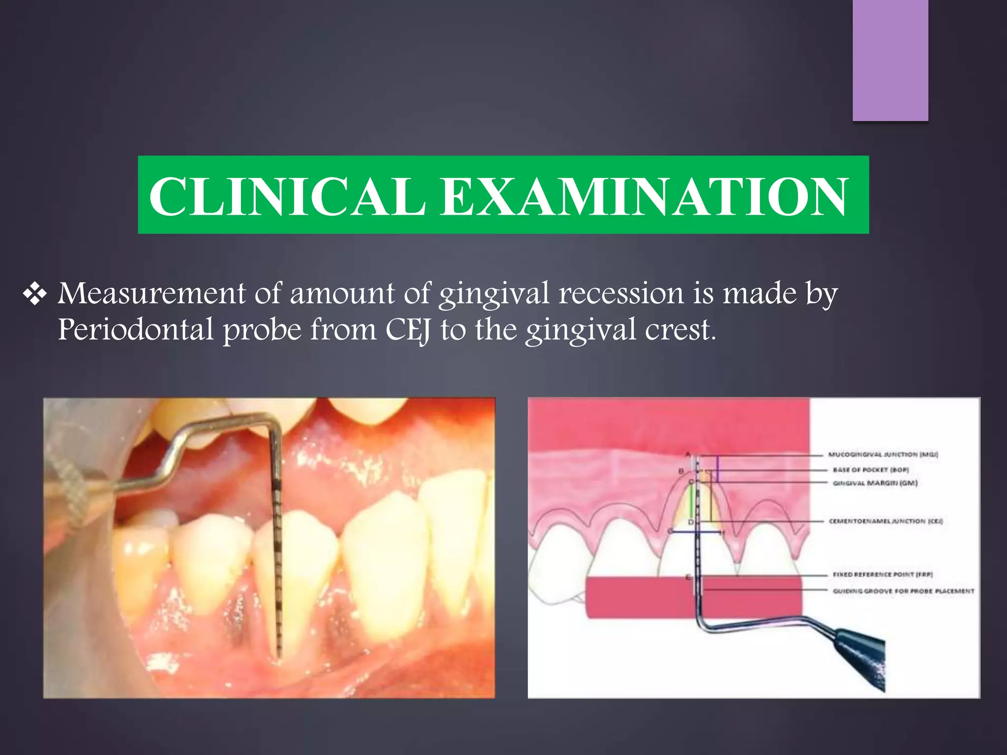 Gingival recession aries | PPTX