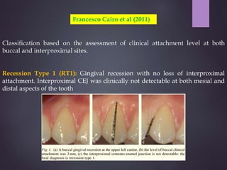 Gingival recession aries | PPTX