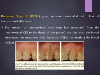 Gingival recession aries | PPTX