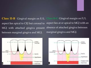 Gingival recession aries | PPTX