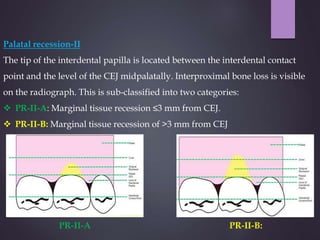 Gingival recession aries | PPTX