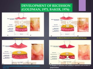 Gingival recession aries | PPTX