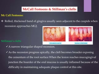 Gingival recession aries | PPTX