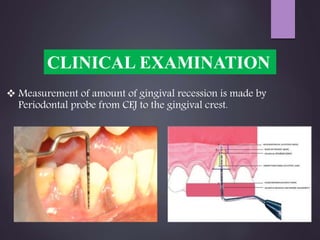 Gingival recession aries | PPTX