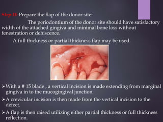 Gingival recession aries | PPTX