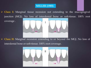 Gingival recession aries | PPTX