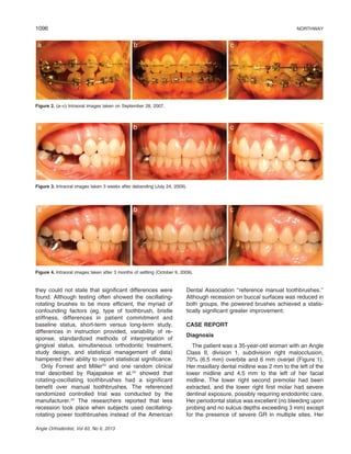 Gingival recession—can orthodontics be a cure? evidence from a case ...