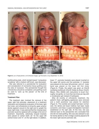 Gingival recession—can orthodontics be a cure? evidence from a case ...