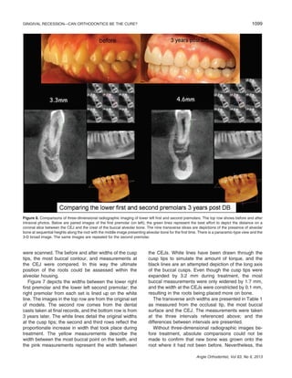 Gingival recession—can orthodontics be a cure? evidence from a case ...