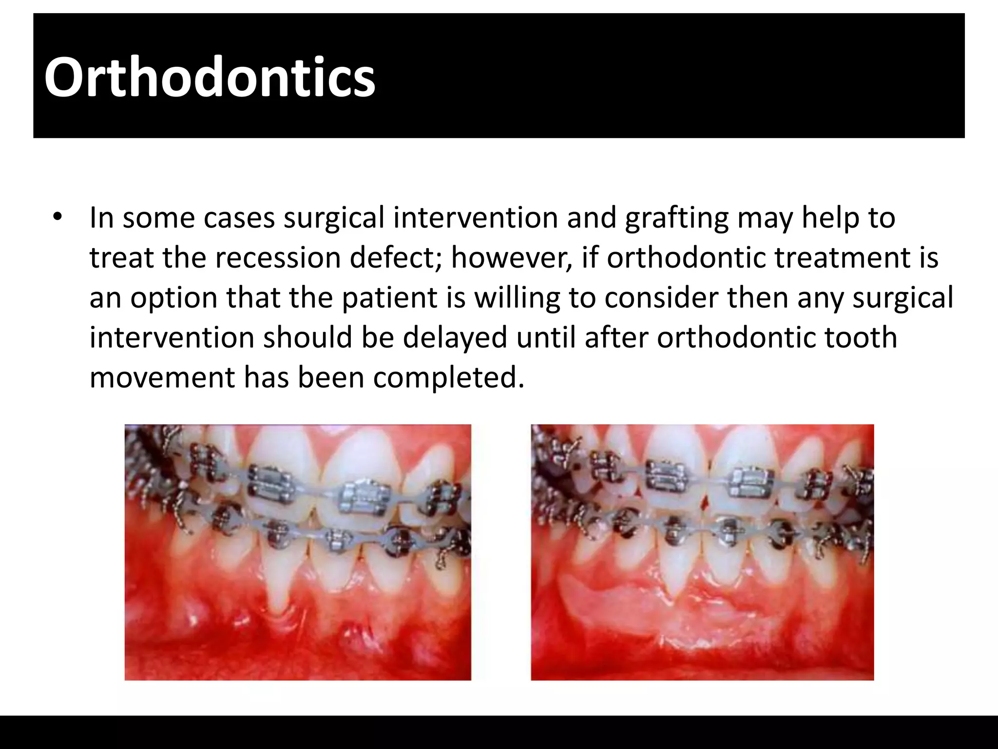 Gingival recession | PPTX