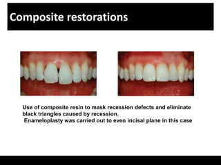 Gingival recession | PPTX