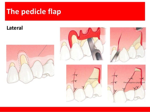 Gingival recession