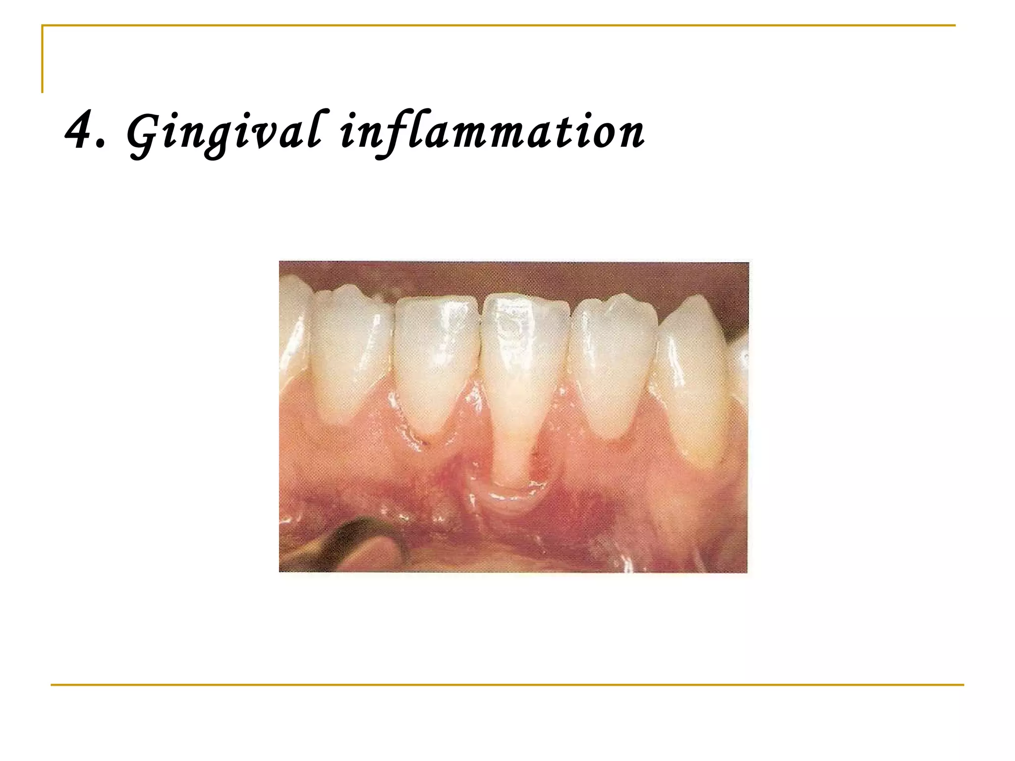 Gingival recession | PPT