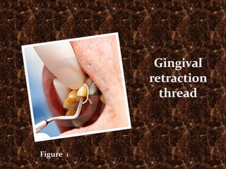 Gingival retraction | PDF
