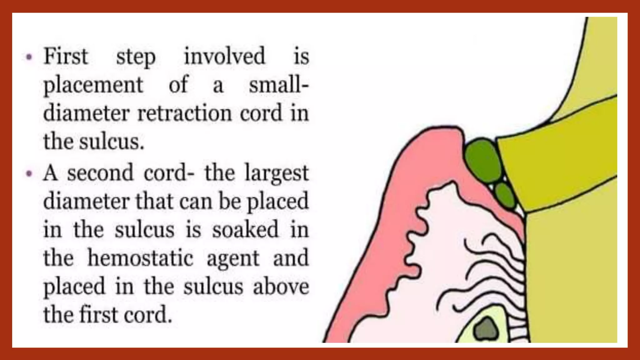 Gingival retraction.pptx