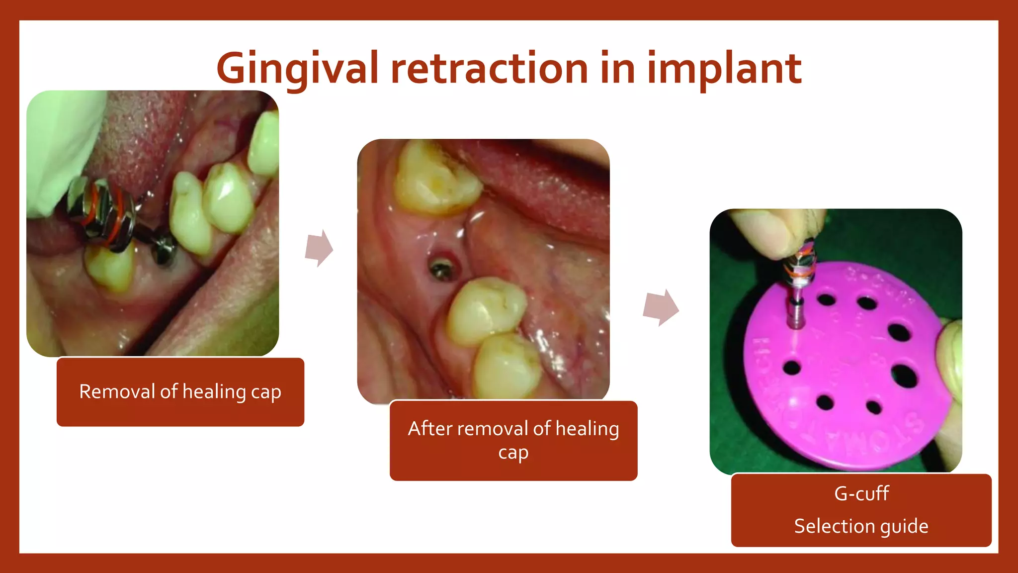 Gingival retraction.pptx