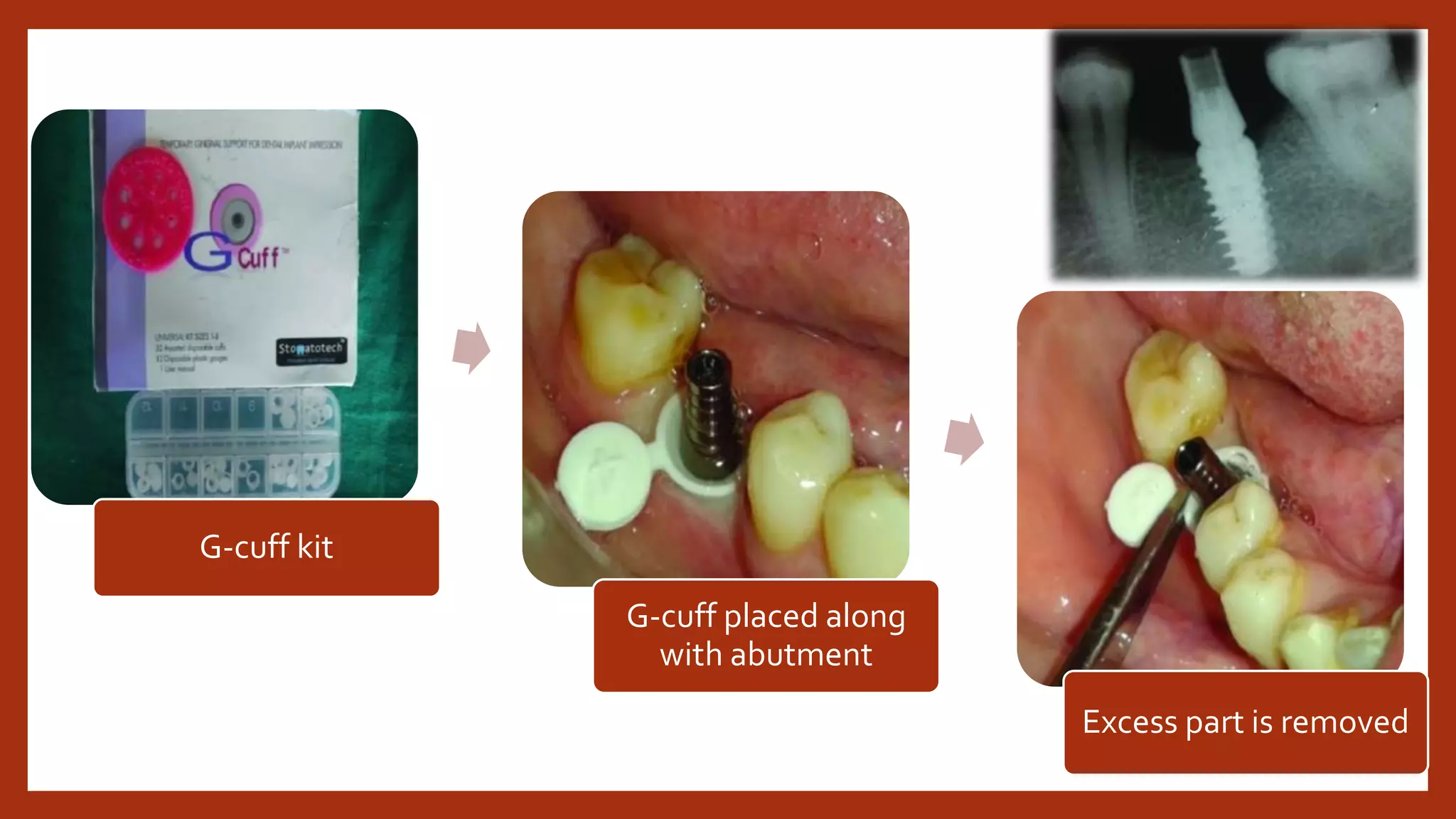 Gingival retraction.pptx