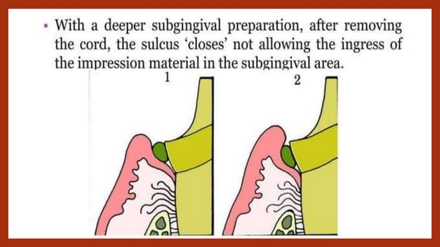 Gingival retraction.pptx