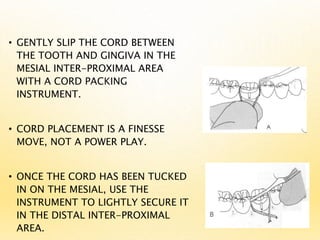 GINGIVAL RETRACTION AND RECENT ADVANCES.ppt