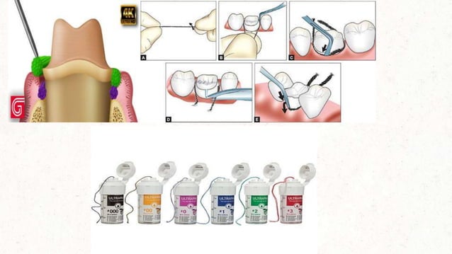 Gingival retraction in implant | PPTX