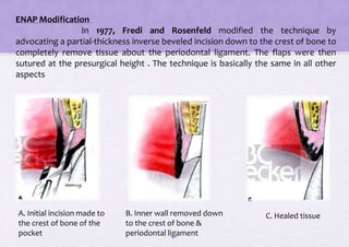 Gingival surgical techniques | PPTX