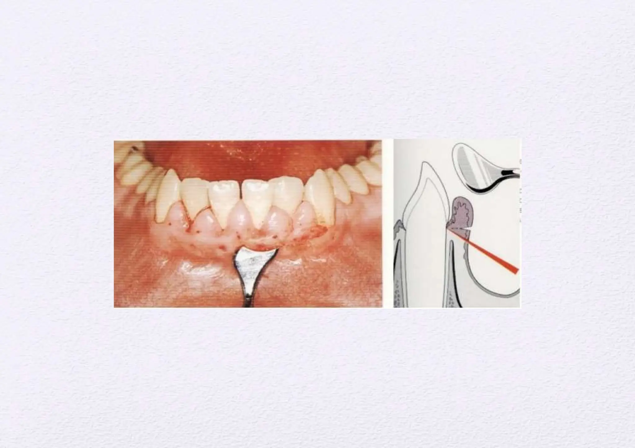 Gingival surgical techniques-Dr Deepthi.pptx
