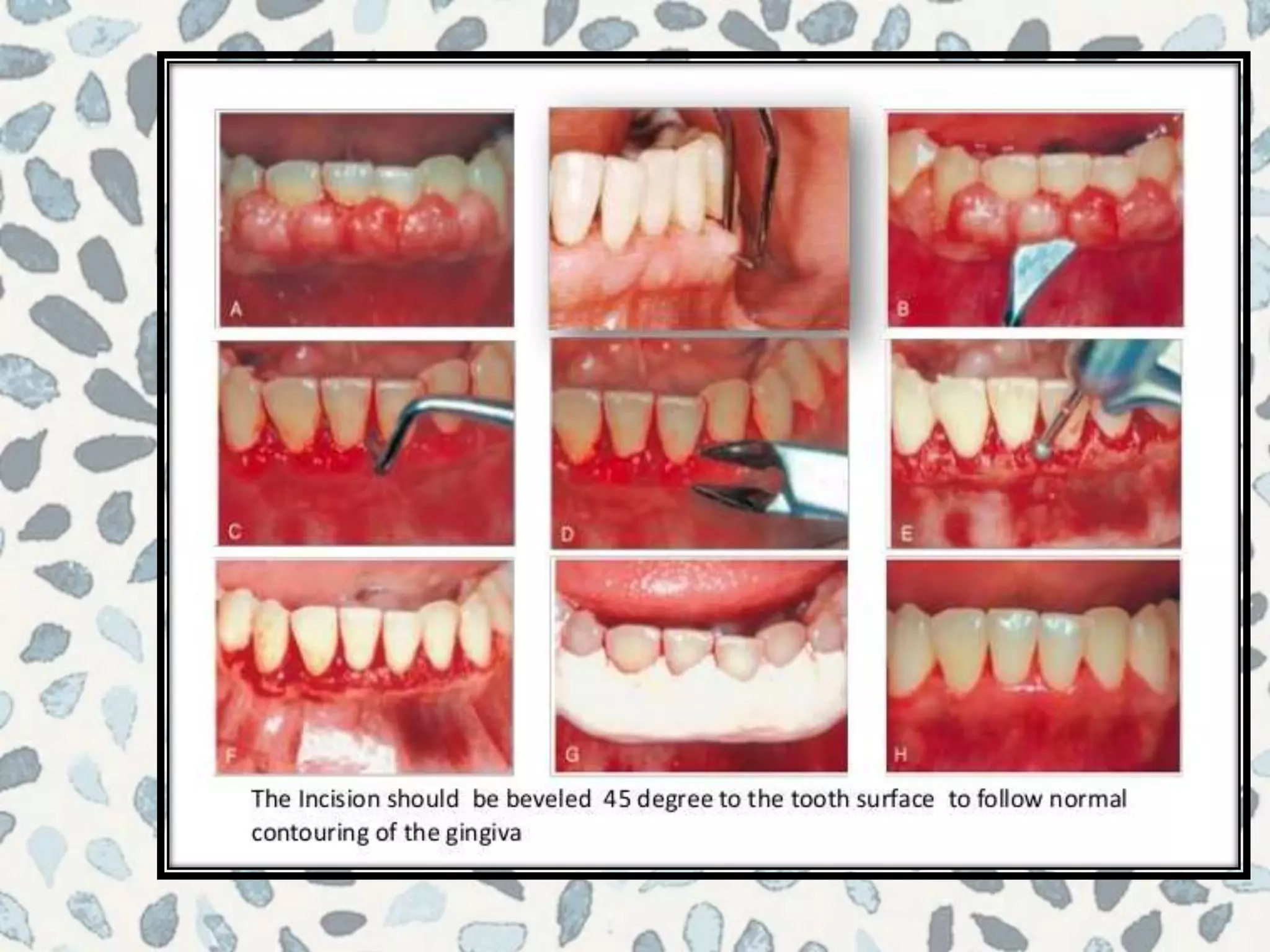 GINGIVAL SURGICAL TECHNIQUES IN PERIODONTOLOGY | PPTX