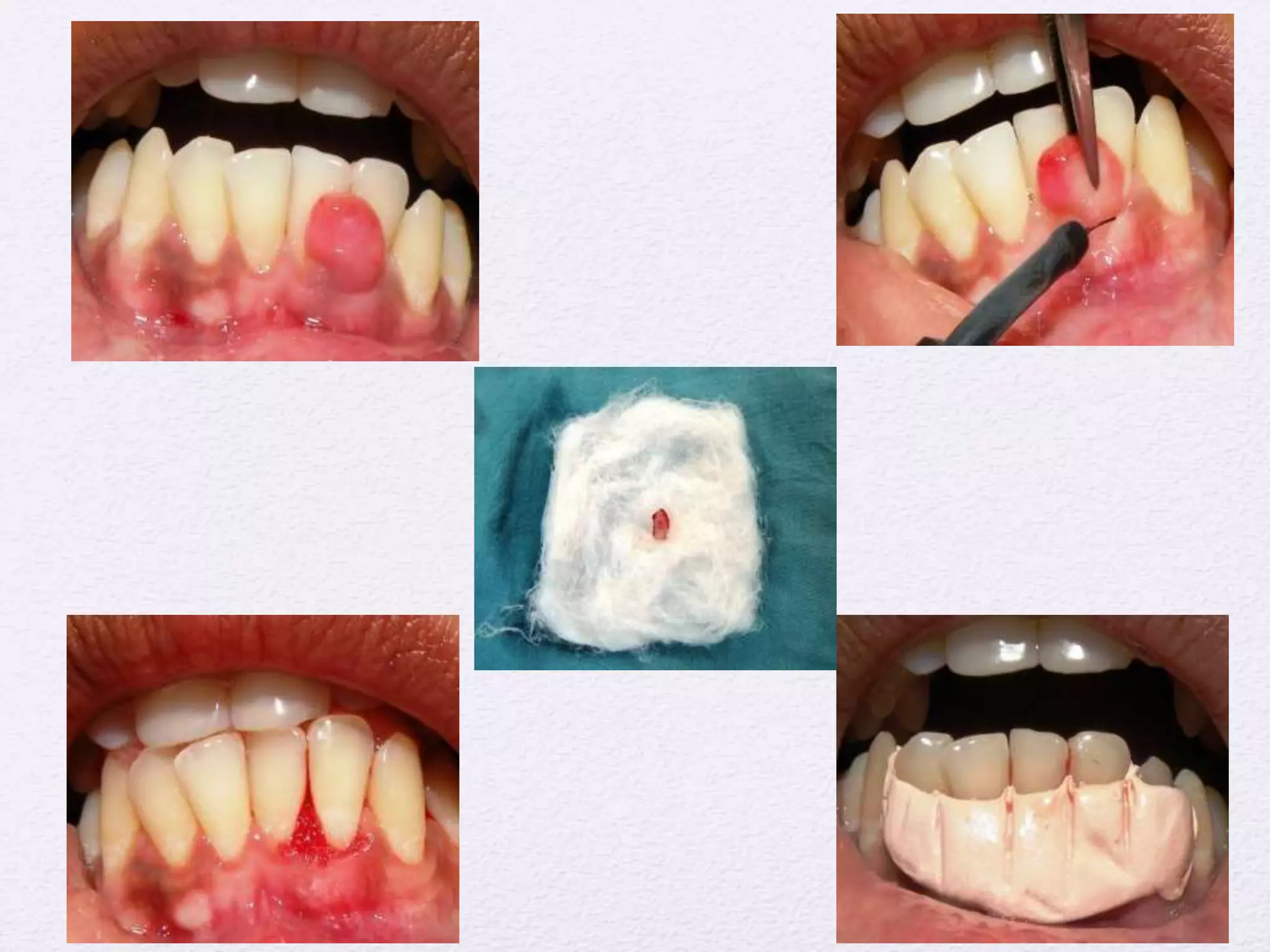 GINGIVAL SURGICAL TECHNIQUES IN PERIODONTOLOGY | PPTX