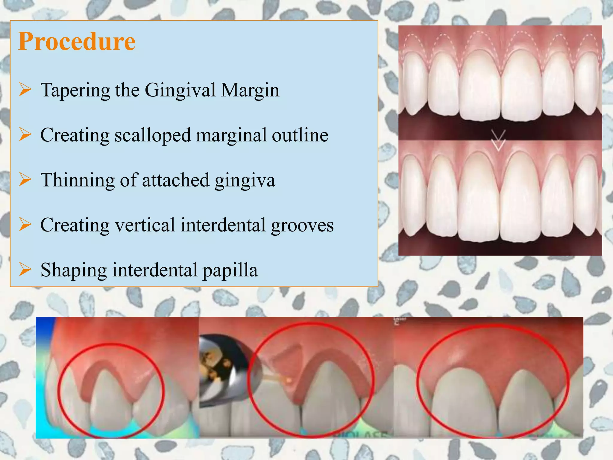 GINGIVAL SURGICAL TECHNIQUES IN PERIODONTOLOGY | PPTX
